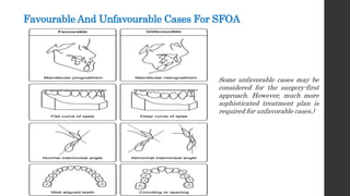 Surgery first orthognathic approach | PPTX