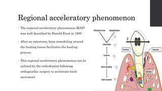 Surgery first orthognathic approach | PPTX