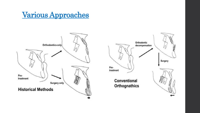 Surgery first orthognathic approach | PPTX | Dental Health | Diseases ...