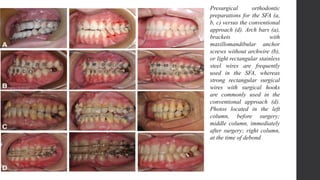 Surgery first orthognathic approach | PPTX