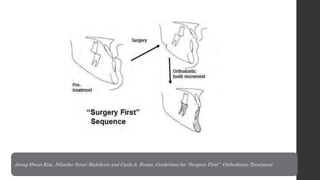 Surgery first orthognathic approach | PPTX | Dental Health | Diseases ...