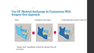 Surgery first orthognathic approach | PPTX