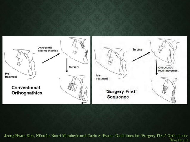 surgery first approach presentation latest | PPTX | Dental Health ...