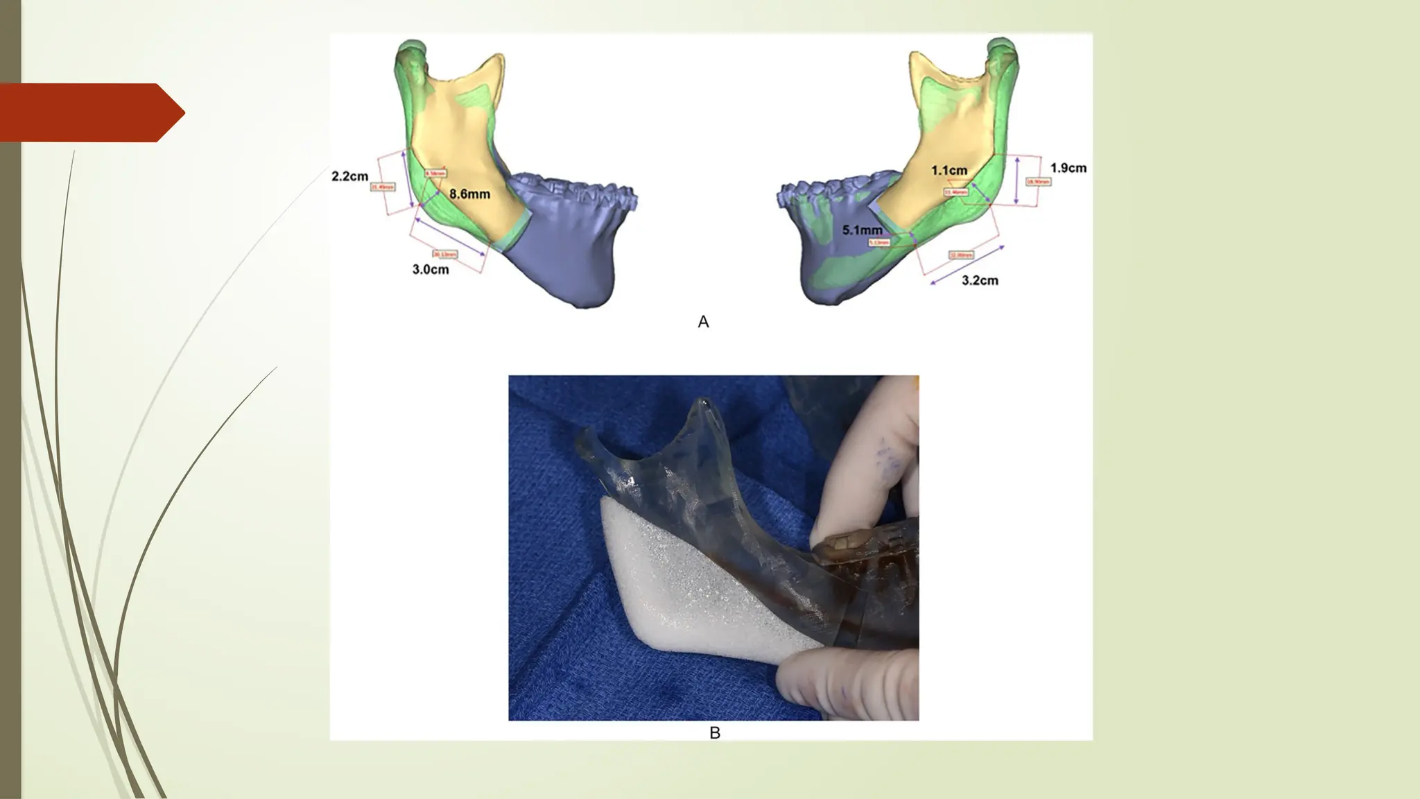 Surgery first in cosmetically driven orthognathic surgery.pptx