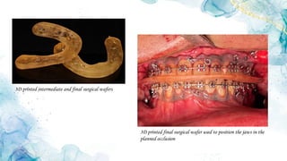 surgery first orthognathic approach-orthodontics and dentofacial ...