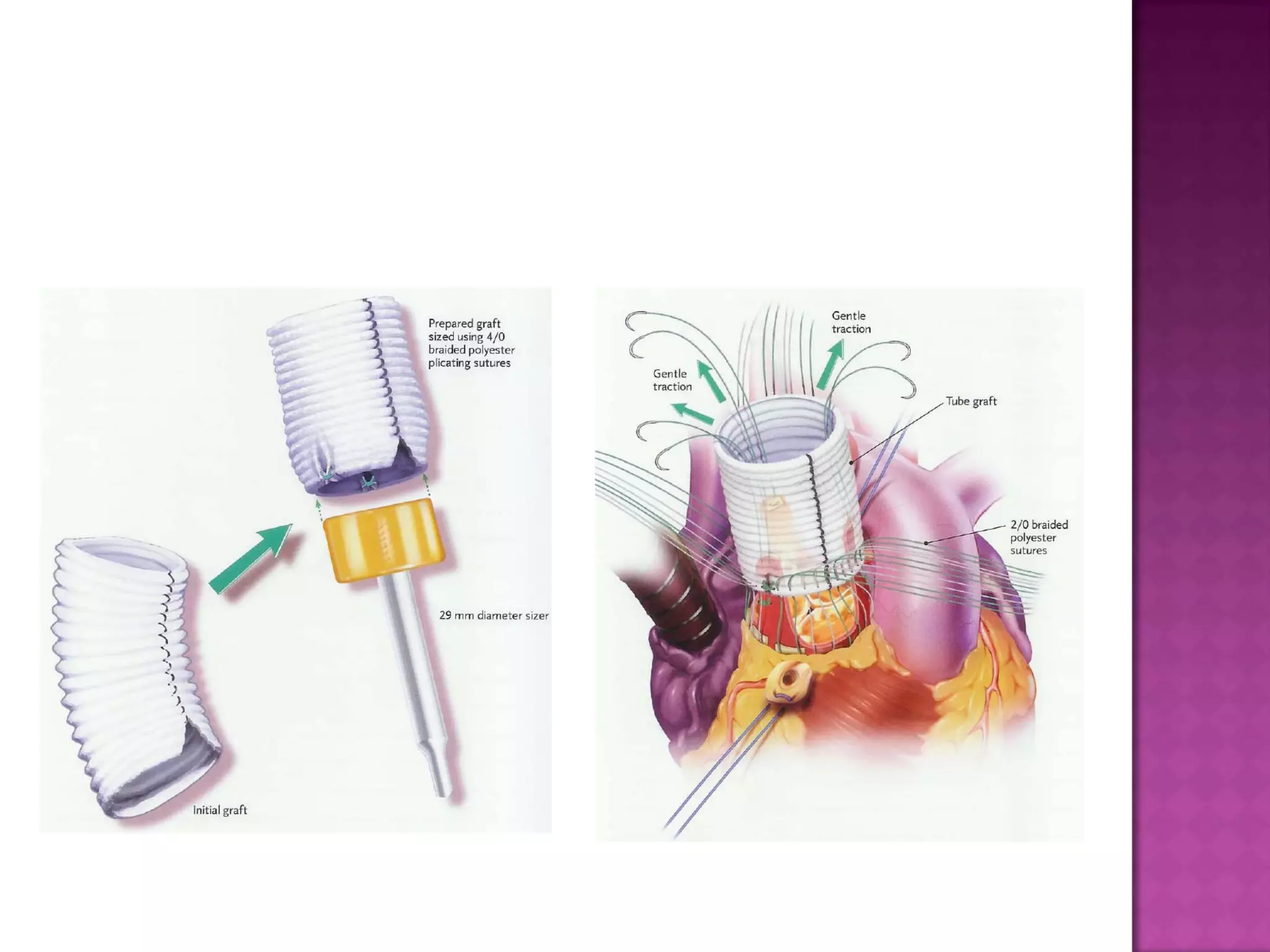 Surgery for aortic root pathologies | PDF