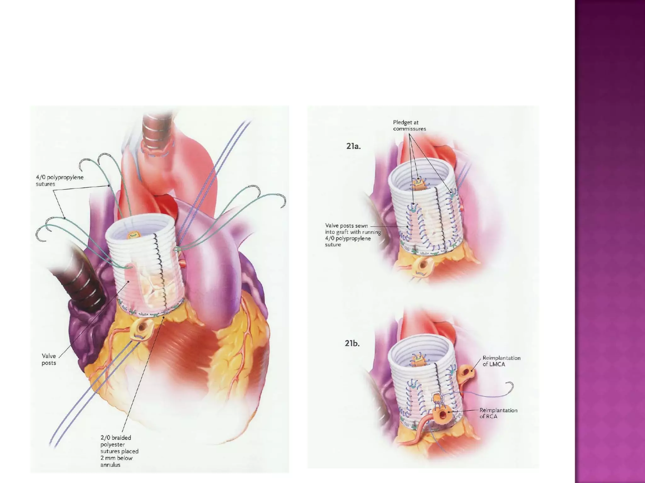 Surgery for aortic root pathologies | PDF