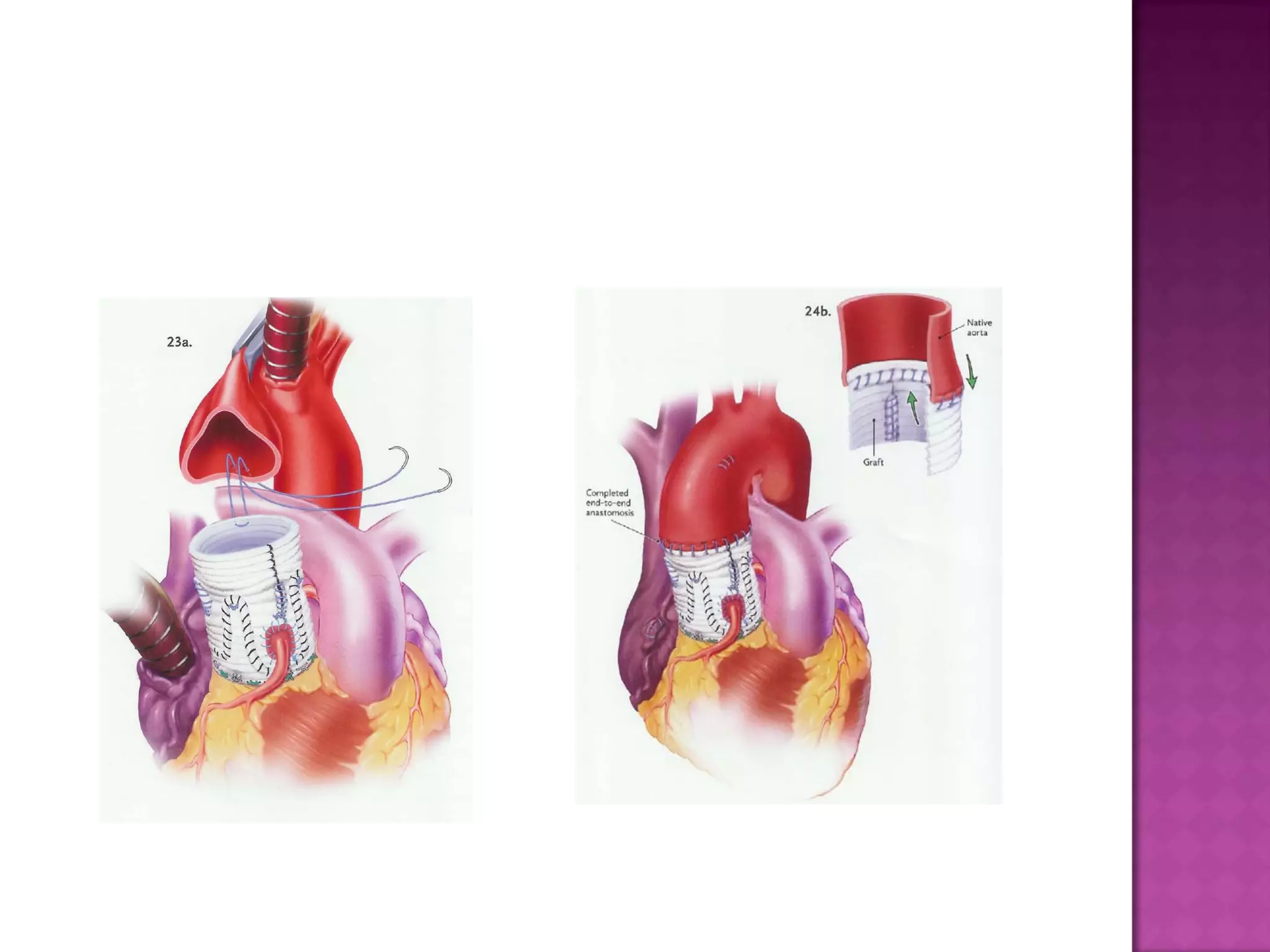 Surgery for aortic root pathologies | PDF