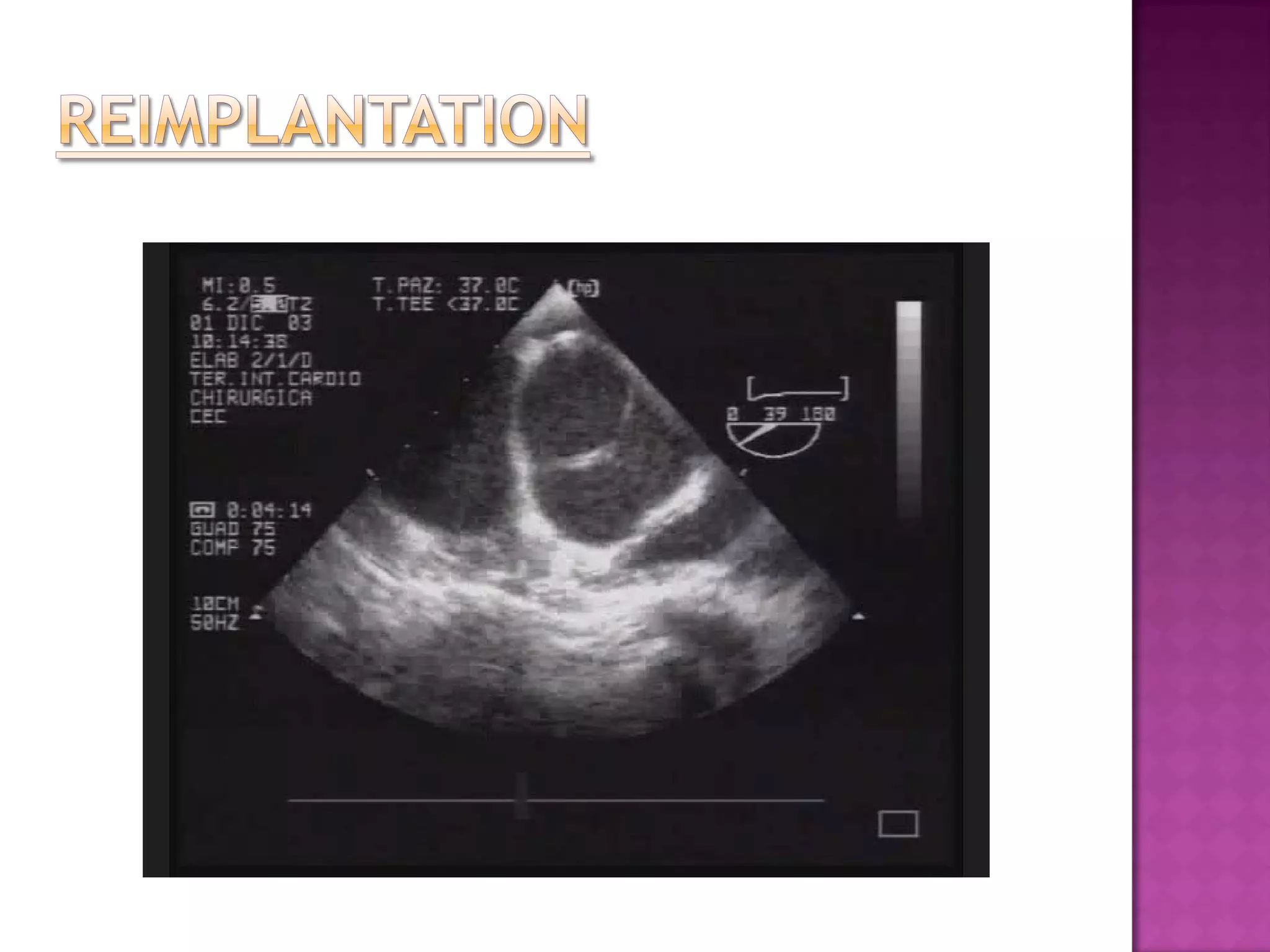 Surgery for aortic root pathologies | PDF