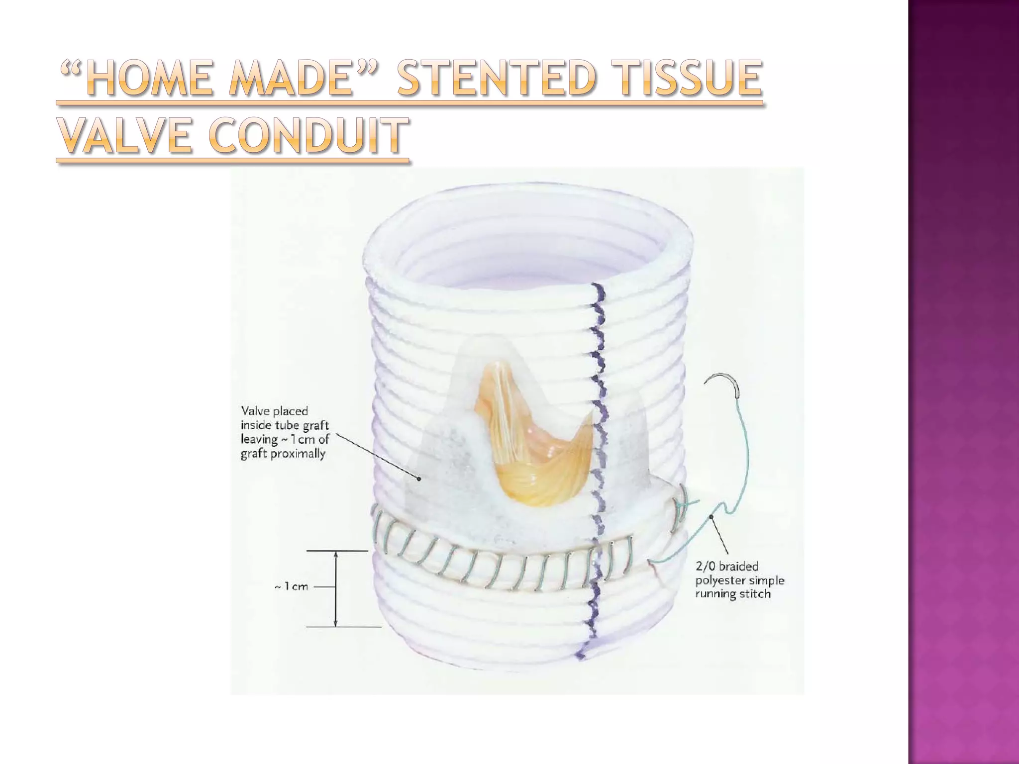 Surgery for aortic root pathologies | PDF