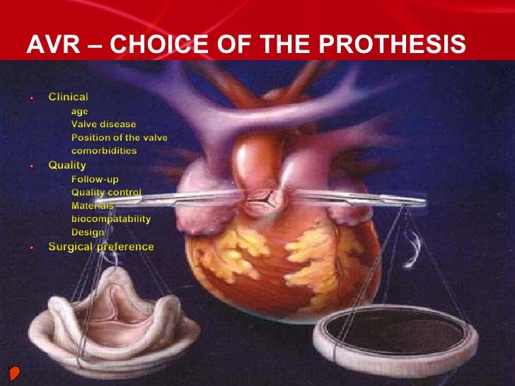 Aortic Valve Stenosis Avs American Heart Association