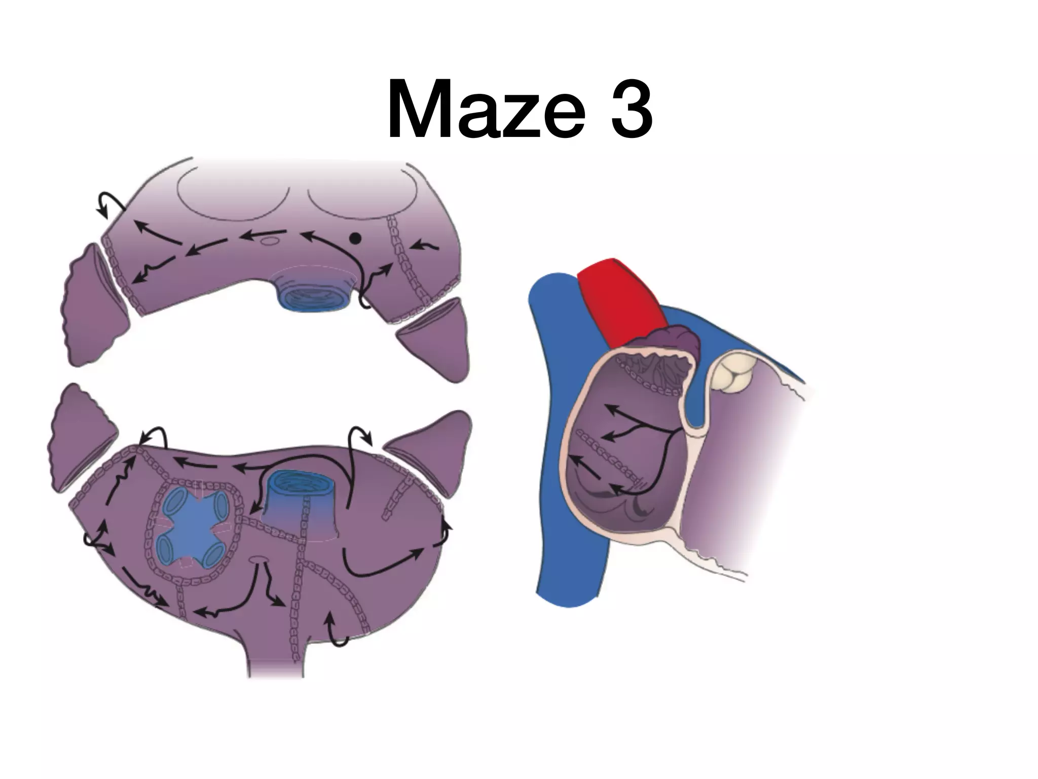 Surgery for atrial fibrillation abhijit presentation | PPT | Free Download