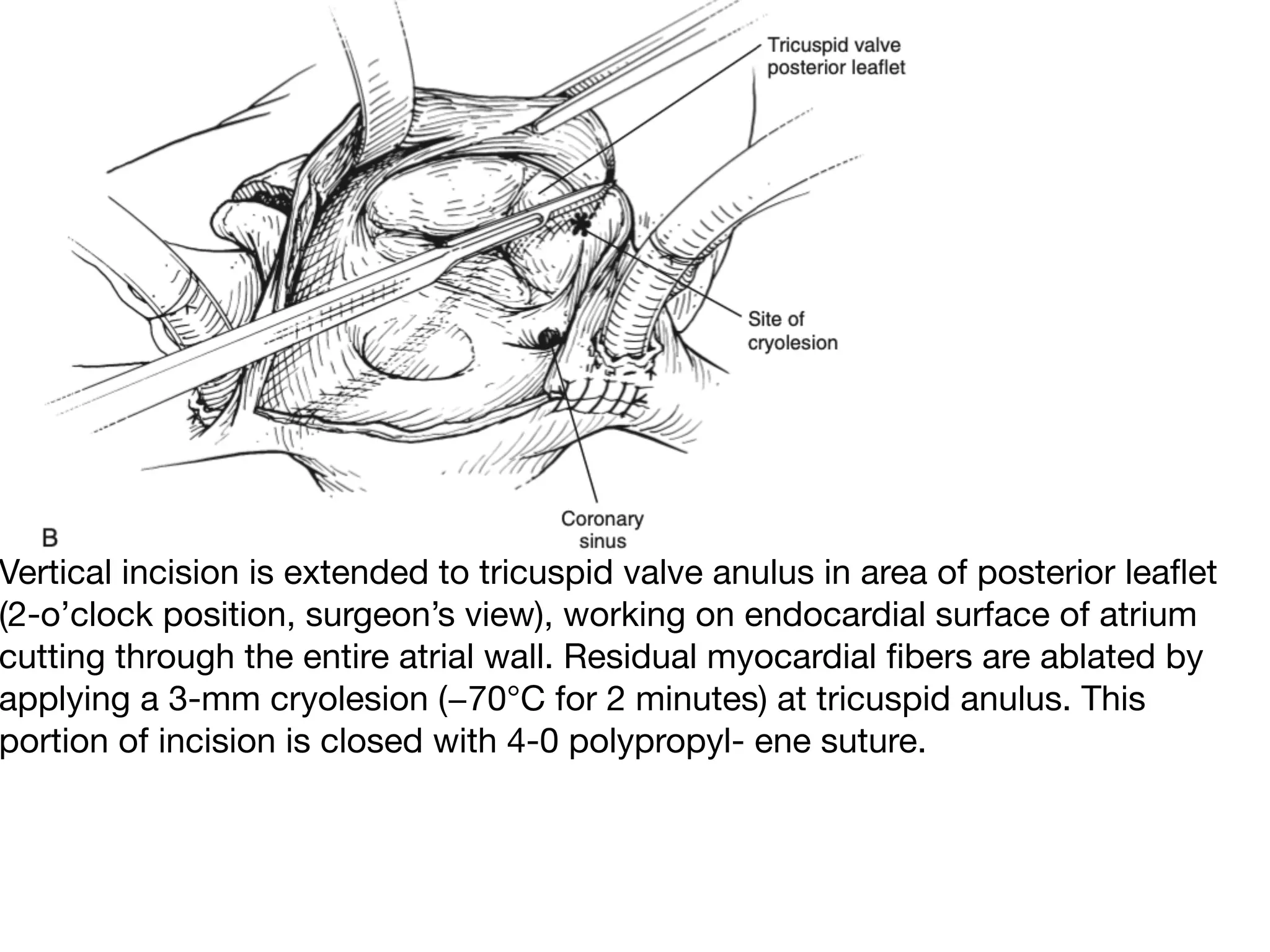 Surgery for atrial fibrillation abhijit presentation | PPT | Free Download