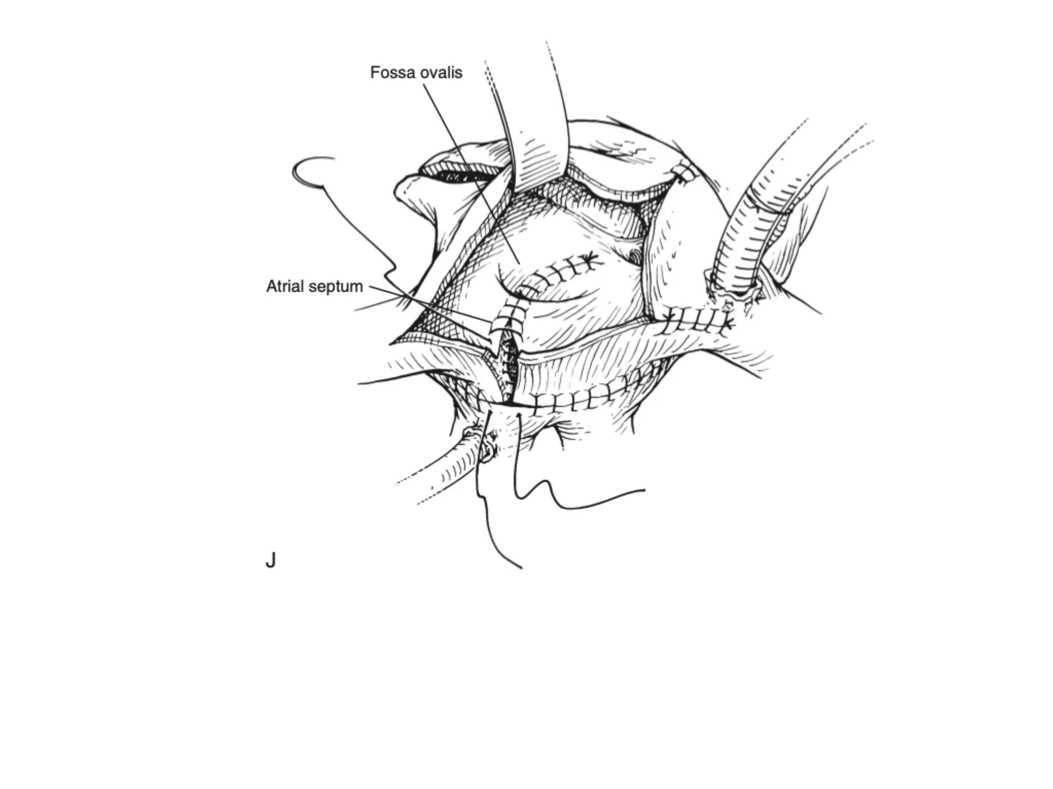 Surgery for atrial fibrillation abhijit presentation | PPT | Free Download