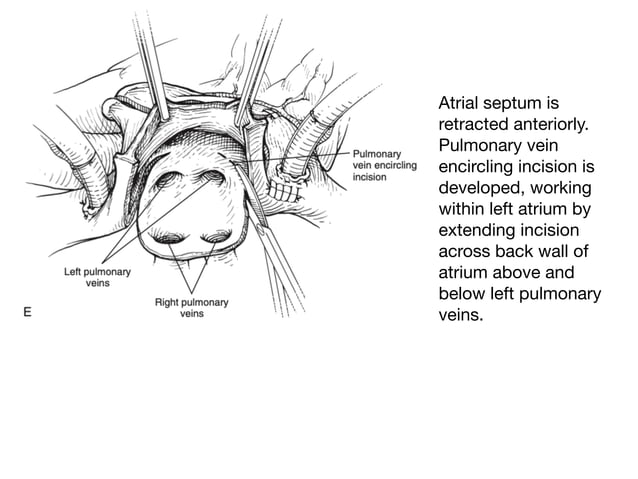 Surgery for atrial fibrillation abhijit presentation | PPT | Free Download