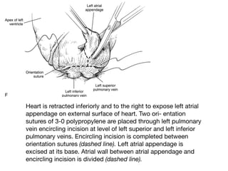 Surgery for atrial fibrillation abhijit presentation | PDF