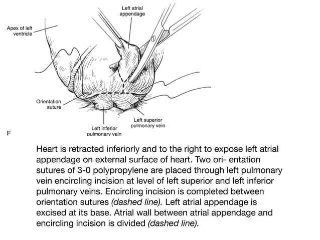 Surgery for atrial fibrillation abhijit presentation | PPT | Free Download