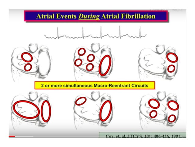 Surgery for atrial fibrillation abhijit presentation | PPT
