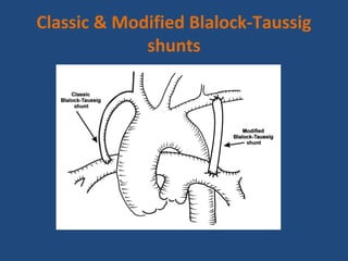 Surgery for Congenital Heart Diseases | PPT