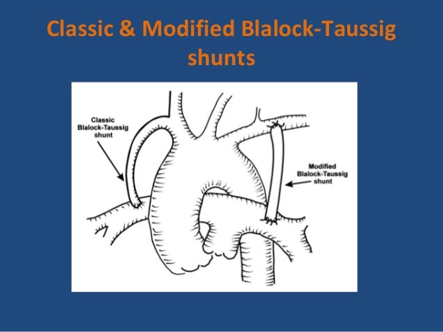 Surgery for Congenital Heart Diseases