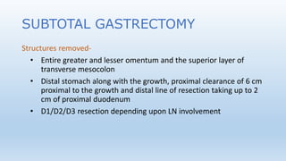 Surgery for gastric ca | PPTX