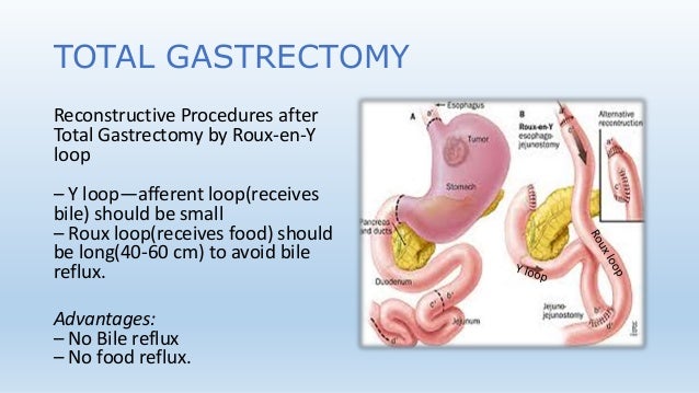 Surgery for gastric ca