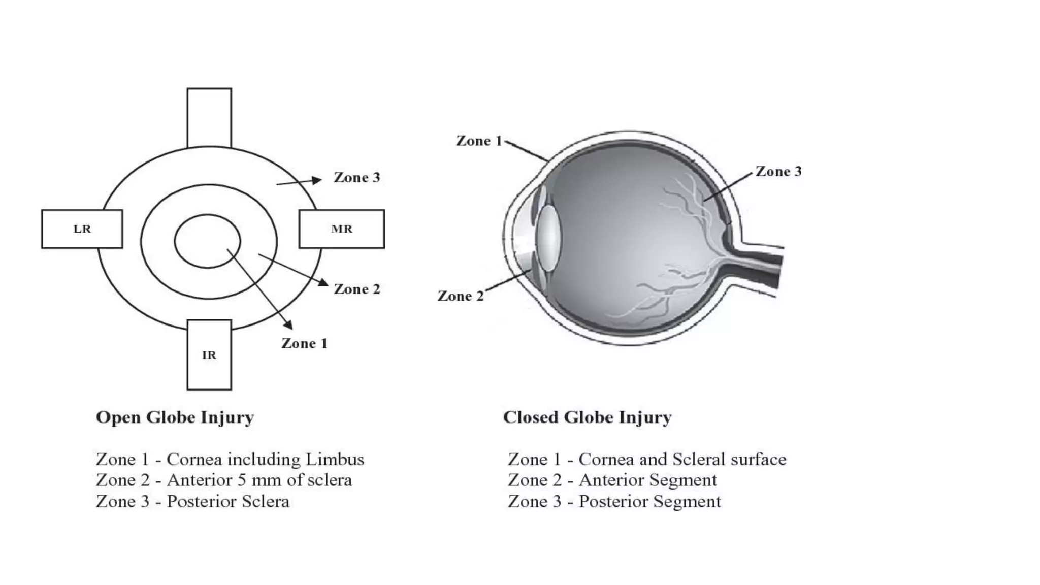 Surgery for ocular trauma | PPTX