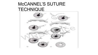 Surgery for ocular trauma | PPTX