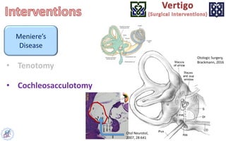 Surgery for vertigo | PDF