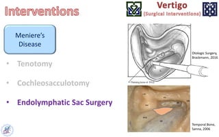 Surgery for vertigo | PDF