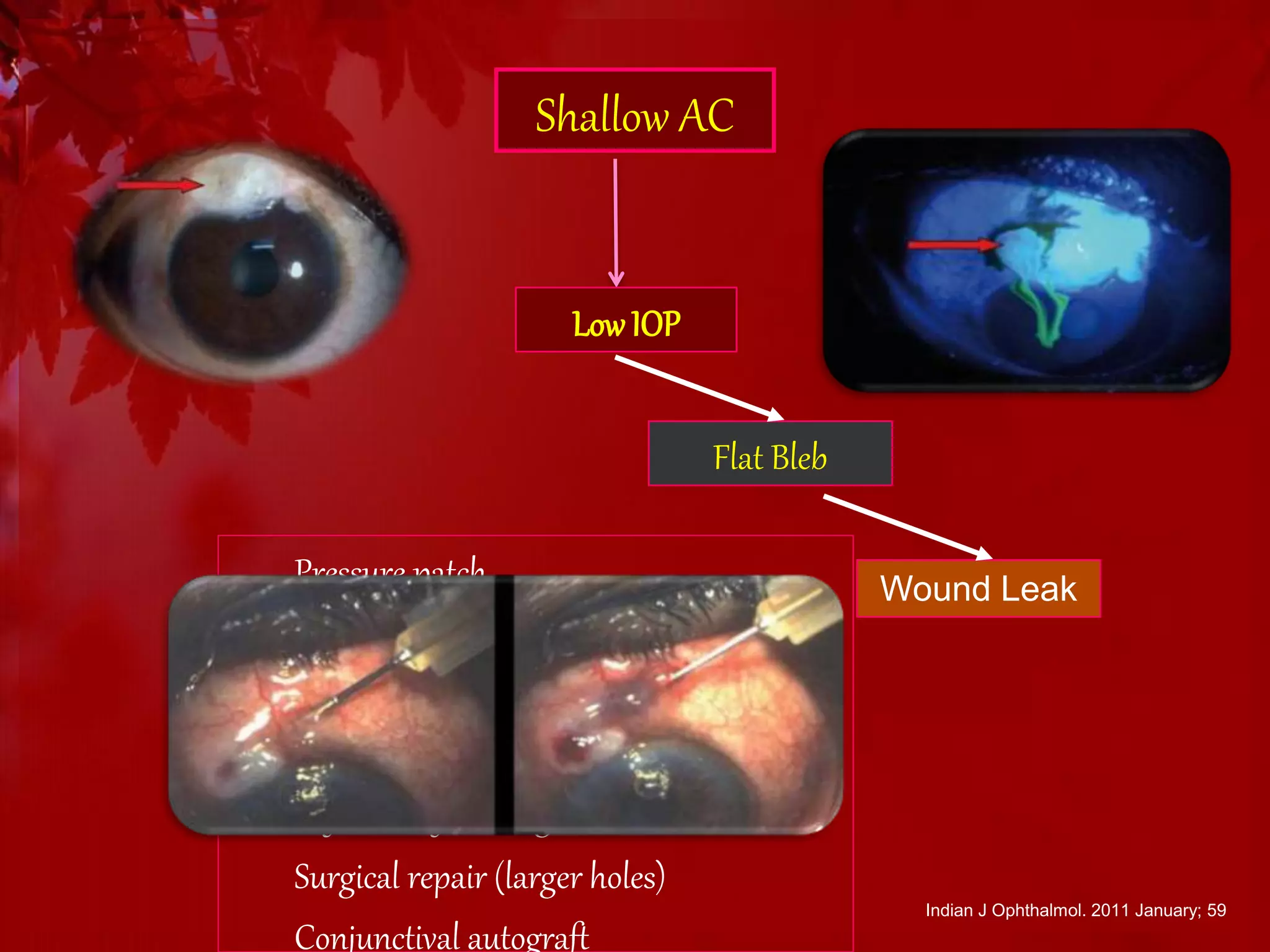 Surgery in open angle glaucoma | PPT