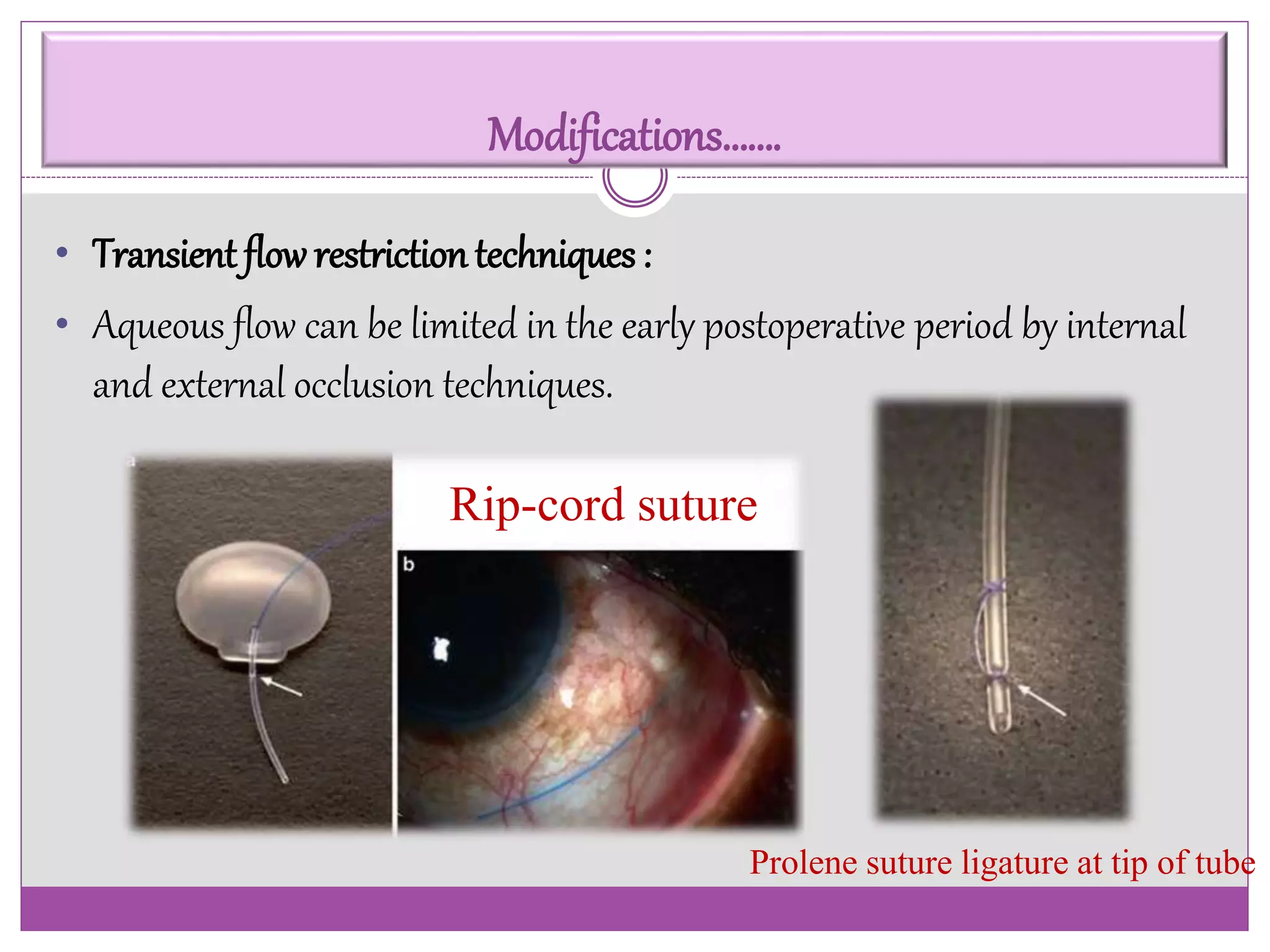 Surgery in open angle glaucoma | PPT