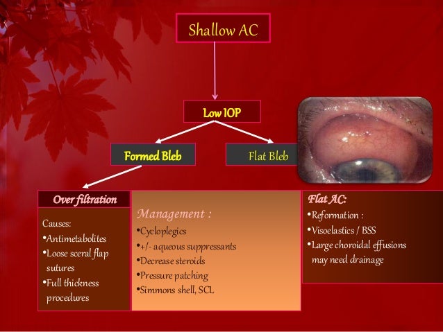 Surgery in open angle glaucoma
