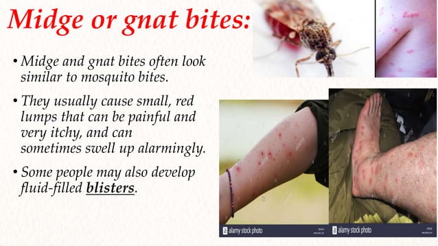 Surgery insects bites | PPTX | Infectious Diseases | Diseases and ...