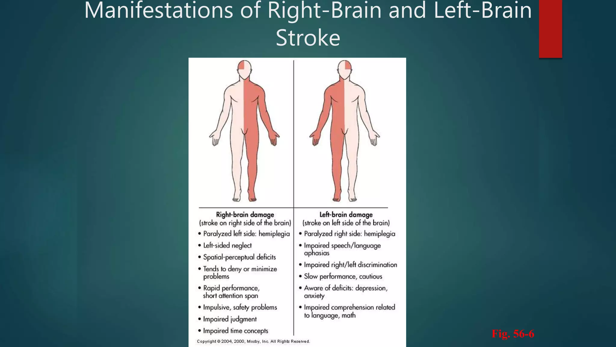 Medical Radiological and Surgical Management of Stroke | PPTX