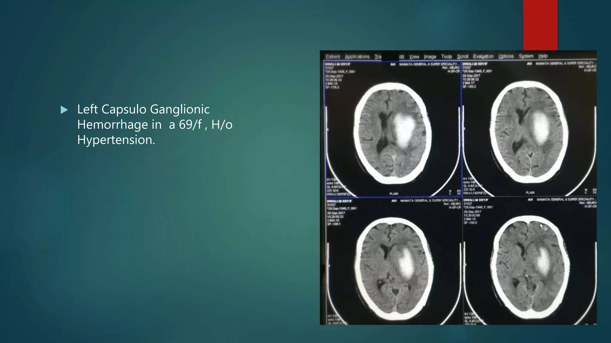 Medical Radiological and Surgical Management of Stroke | PPTX