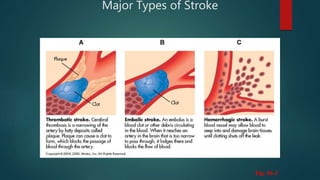 Medical Radiological and Surgical Management of Stroke | PPTX