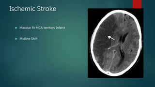 Medical Radiological and Surgical Management of Stroke | PPTX