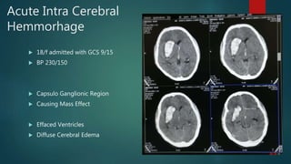 Medical Radiological and Surgical Management of Stroke | PPTX