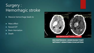Medical Radiological and Surgical Management of Stroke | PPTX