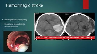 Medical Radiological and Surgical Management of Stroke | PPTX