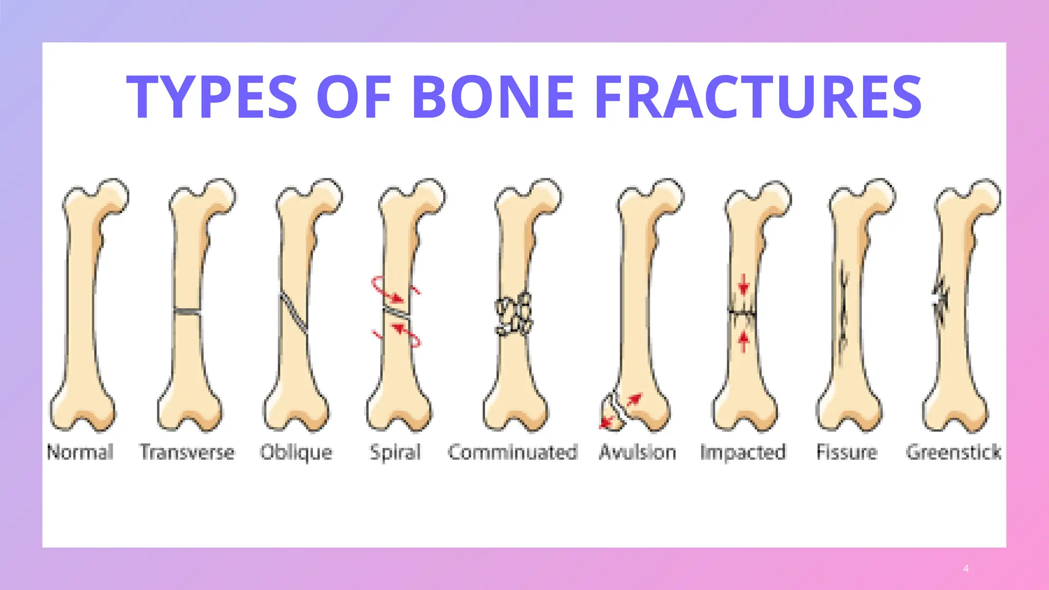 Fractures of Upper Extremity.pptx / Humerus fracture, colle's fracture, boxer's fracture ...