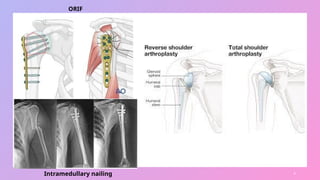 Fractures of Upper Extremity.pptx / Humerus fracture, colle's fracture ...