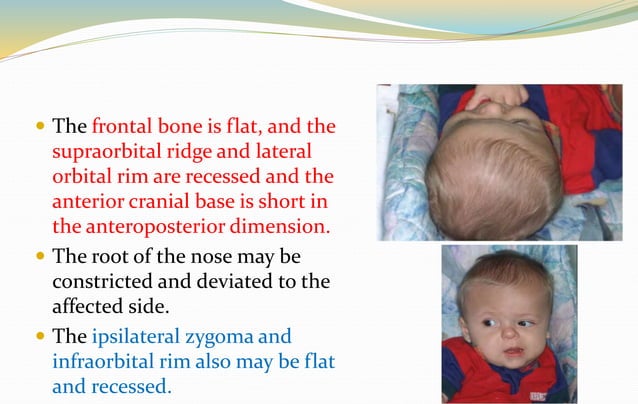 SURGERY OF CRANIOFACIAL ANOMALIES.pptx