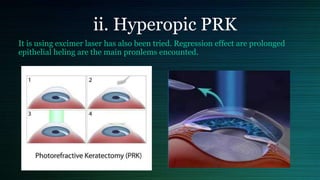 Surgical Management of hypermetropia.pptx