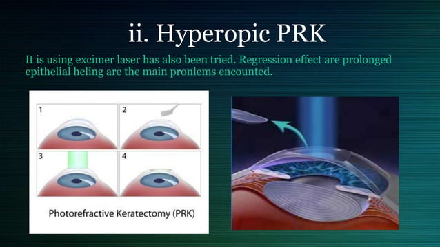 Surgical Management of hypermetropia.pptx | Eye and Vision Conditions ...