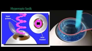 Surgical Management of hypermetropia.pptx