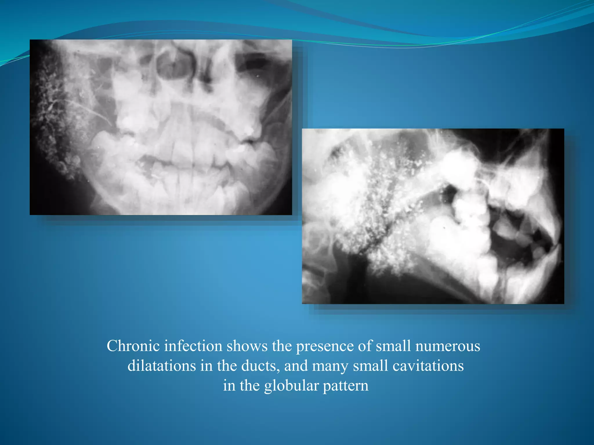 Surgery of Salivary Gland Disorders | PPTX