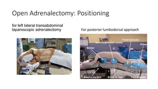 Surgery of the adrenals | PPTX