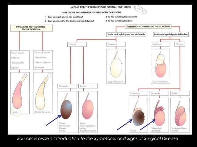 Painless scrotal swelling